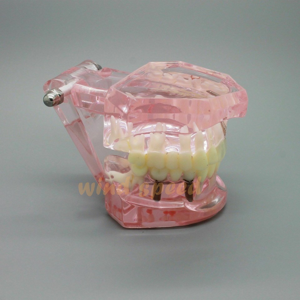 Dental Implant Teeth Model Study Analysis Demonstration Disease ...