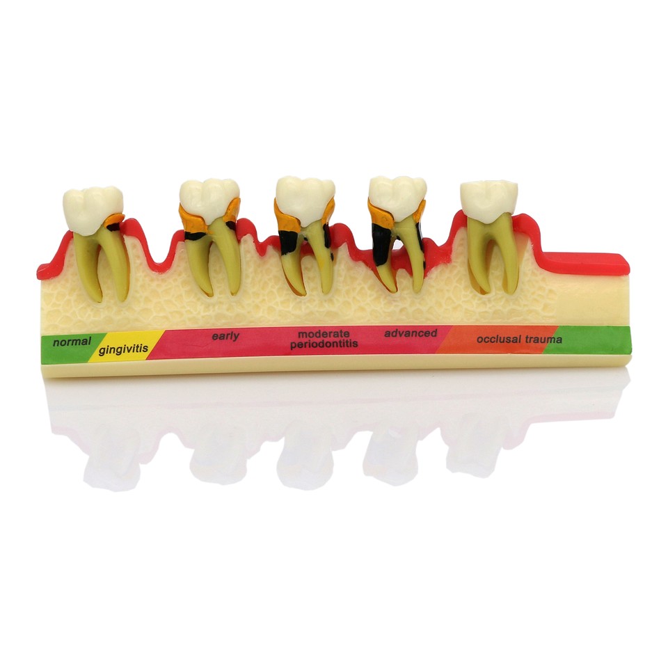 Dental 5-Stage Periodontics Disease Teeth Model Periodontics Assort ...