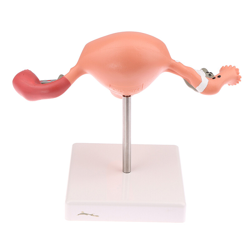 Pathological Uterus And Ovary Anatomical Model Human Female Medical ...