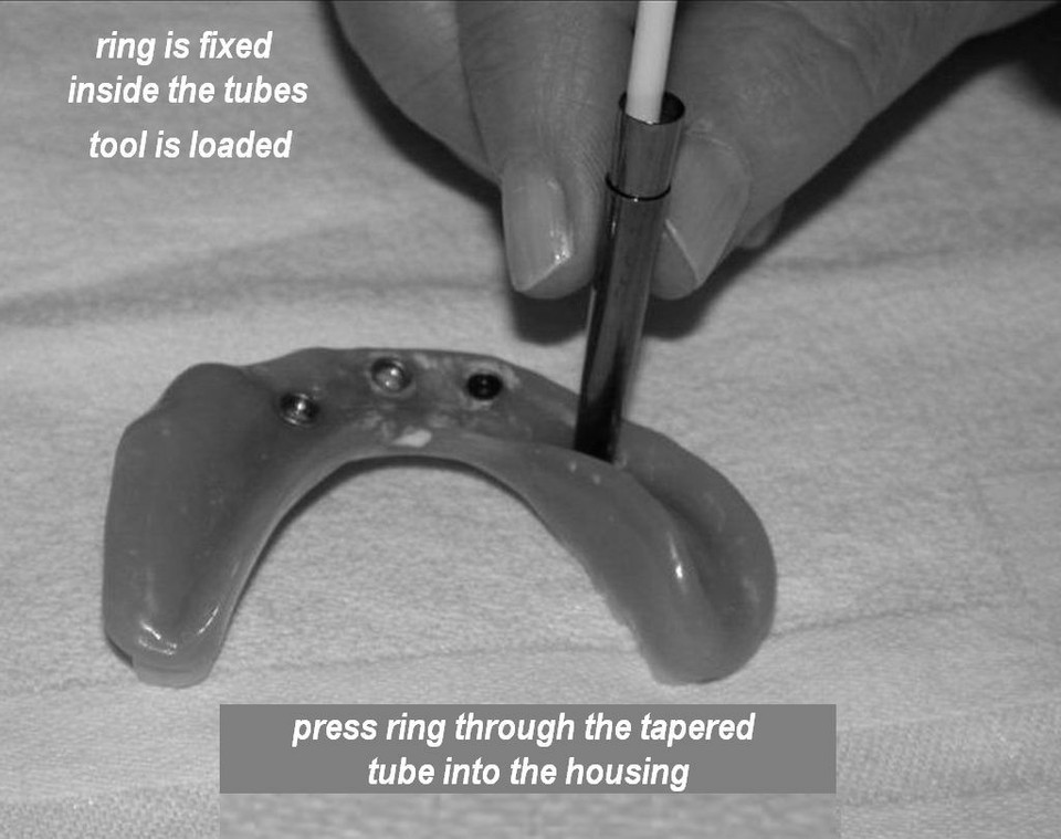 TOOL # 3 for mini dental implant rubber rings comes with 12 * o-rings ...