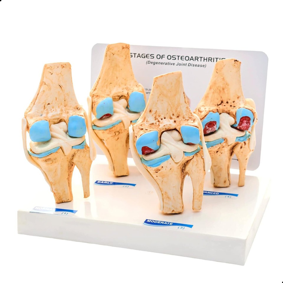KNEE JOINT ARTHRITIS MODEL | 4 Stage Osteoarthritis | For Demonstration ...
