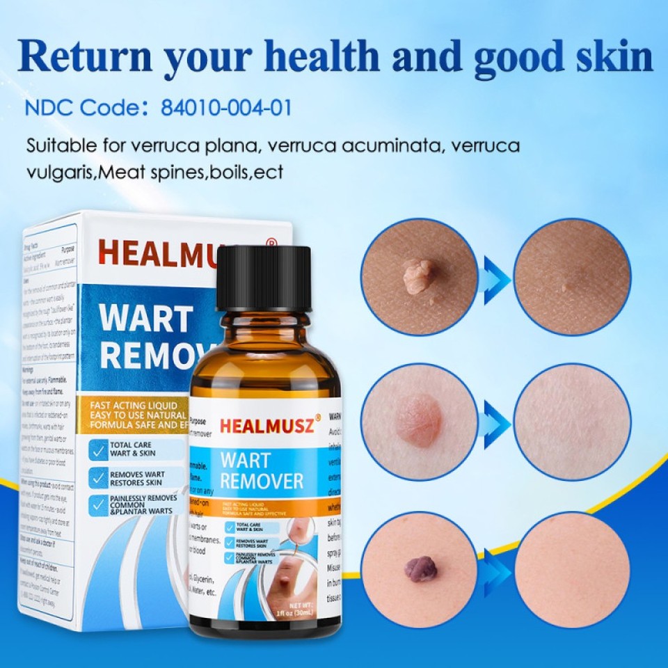 Wart Remover Liquid Skin Tag Mole Remover Eliminate Feet Corn Wart ...