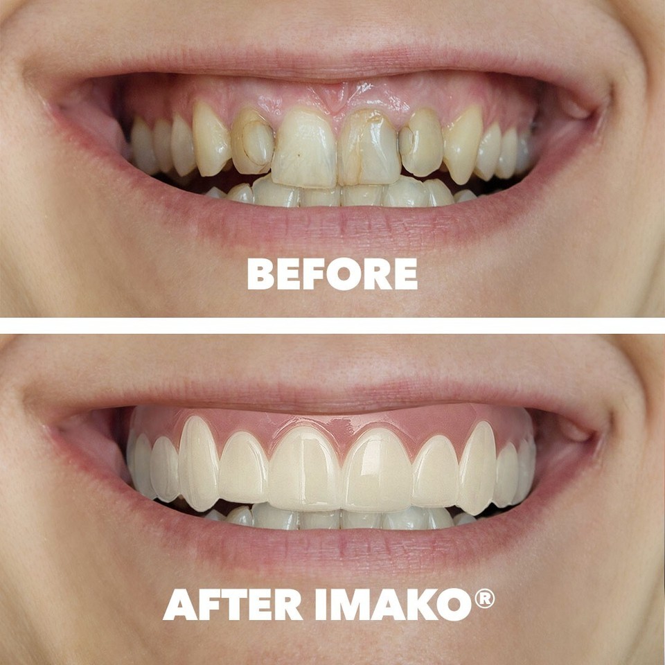 Imako® Premium Cosmetic Teeth Large Natural White -DIY Smile Makeover ...