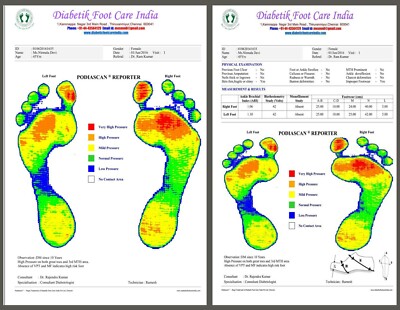 Plantar Pressure Mapping Gait Analysis Harris Mat Foot Scanner ...
