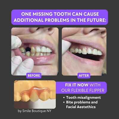 Home Impression Kit for Partial Dentures, Flippers, Removable Veneers ...