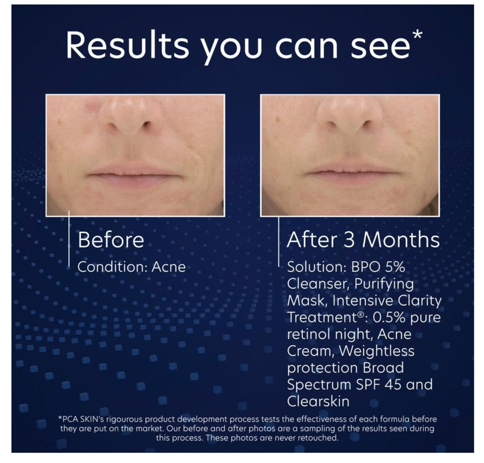 1x PCA Skin BPO 5% CLEANSER 7 fl oz / 206.5 ml Benzoyl Peroxide NIB ...