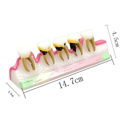5-Stage Periodontal Disease Model - Dental Teaching Tool For Gum ...