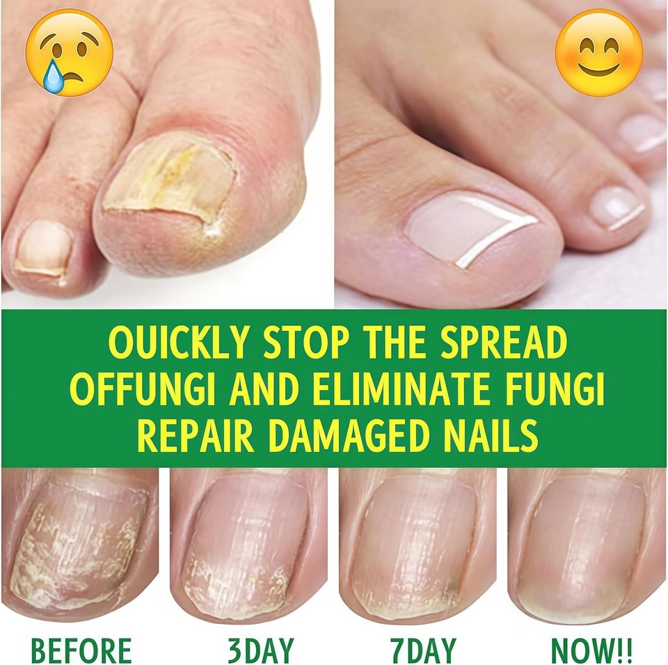 Fungal Nail Treatment Strong Fungus Remover Antifungal Liquid Serum ...
