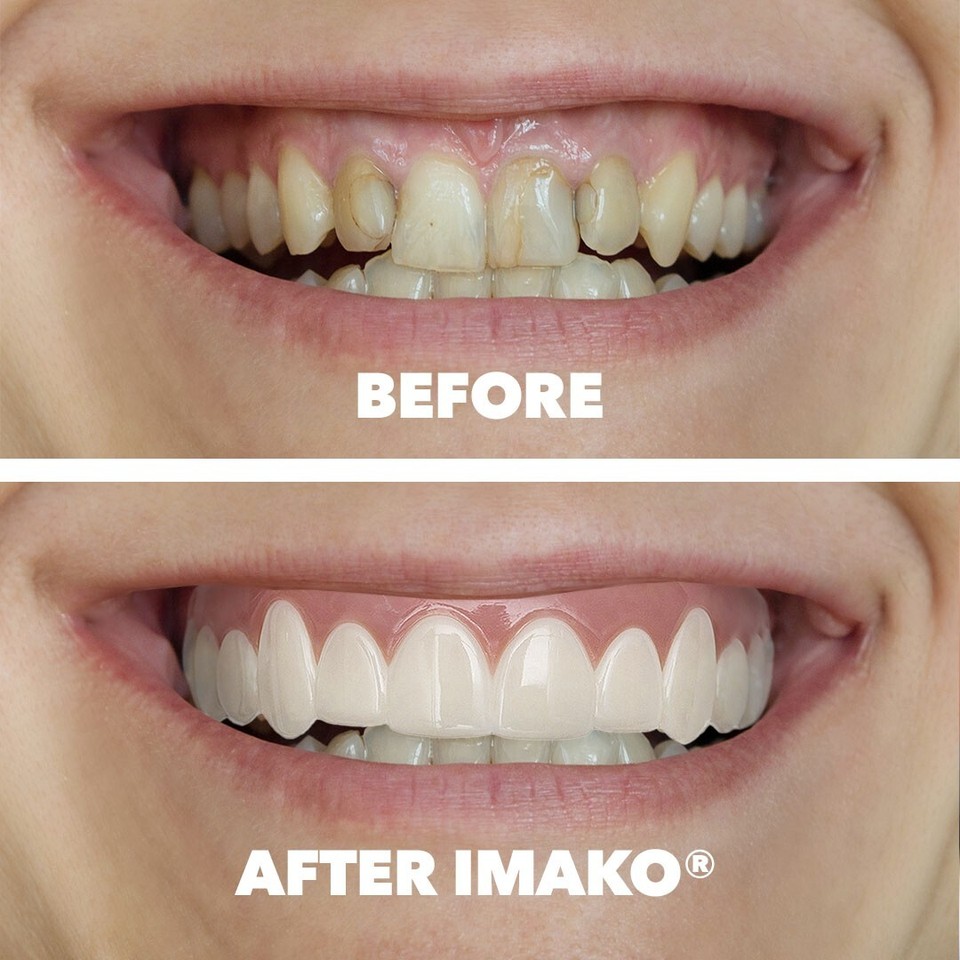 Imako® Premium Cosmetic Teeth Small Natural White -DIY Smile Makeover ...