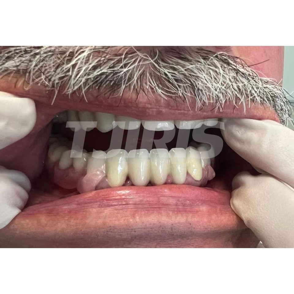 Dental Flexible Partial Dentures 3D Printing Resin for DLP LCD Printer ...