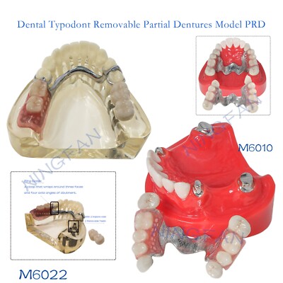Dental Typodont Removable Partial Denture Model ,PRD Telescopic Crown ...