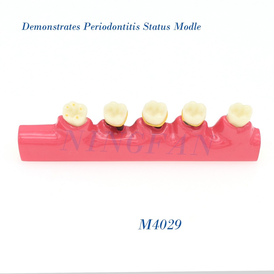 Dental Study Teaching Model Periodontal Disease Assort Teeth Dentoform ...