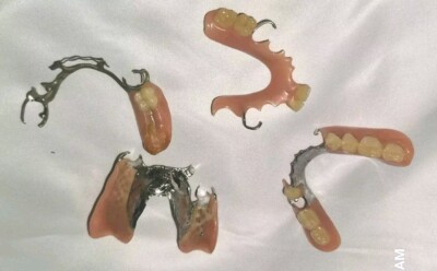Metal Partial Dentures, Dental Teeth, Dentist White Metal Scrap ...