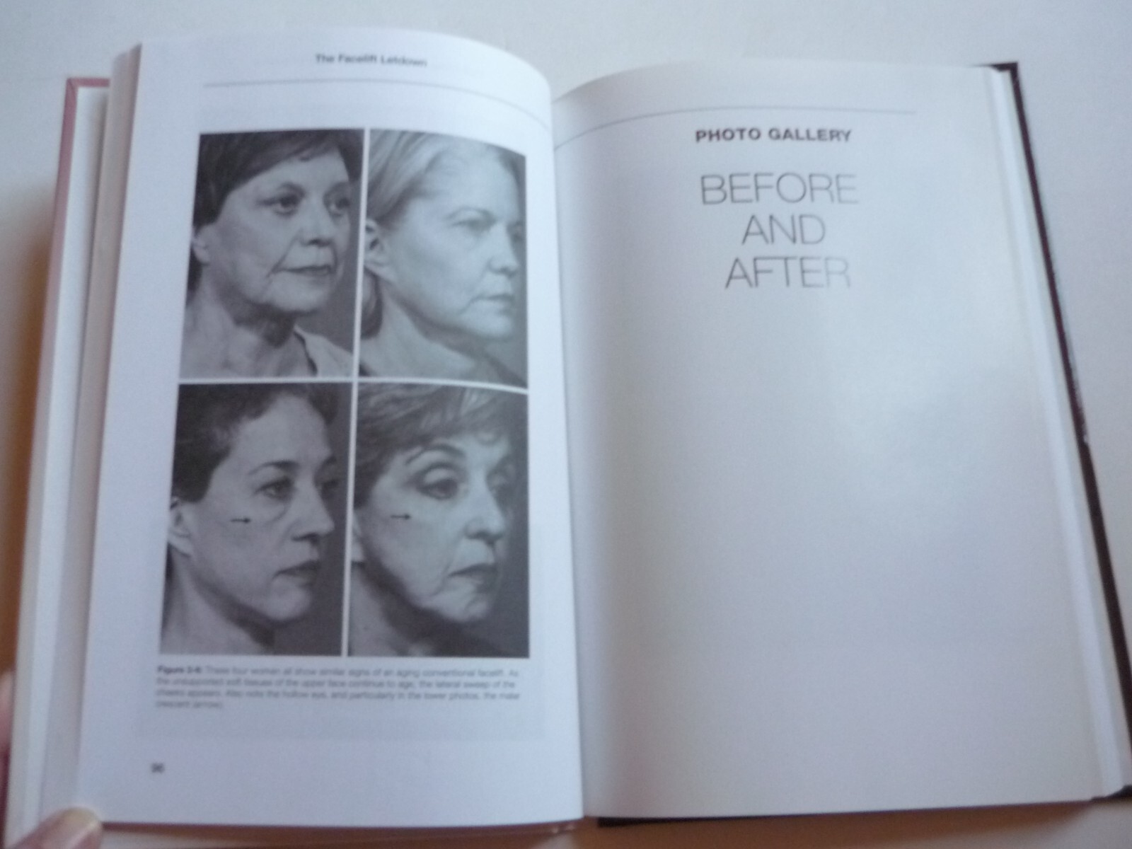 THE FACELIFT LETDOWN: WHEN RESULTS DON'T MEET EXPECTATIONS By Hamra M.d ...