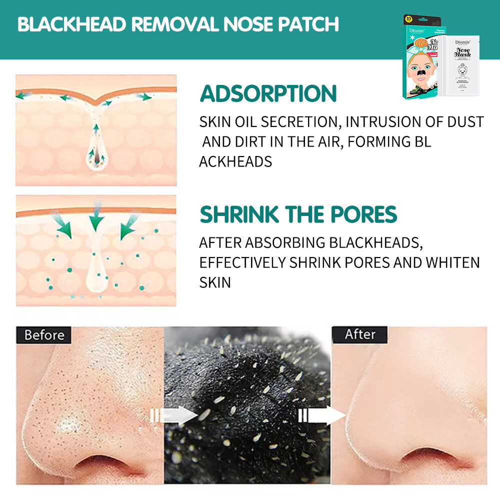 Blackhead Removal On Nose