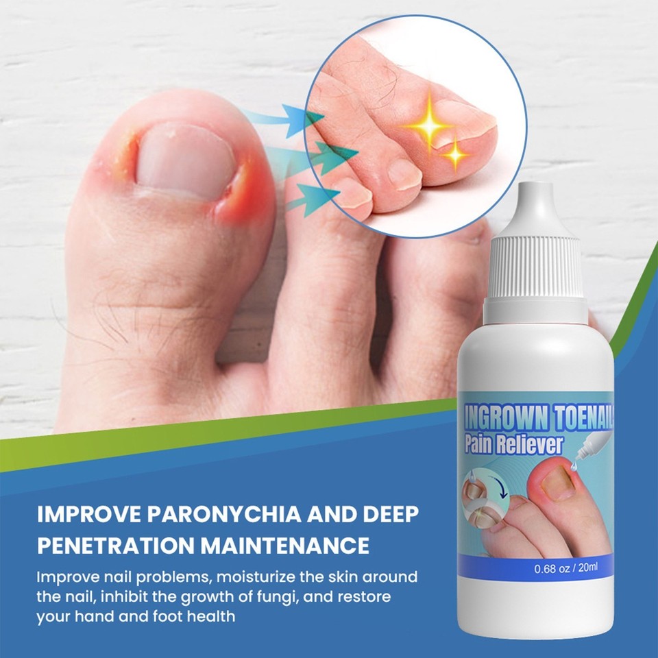 Ingrown Toenail Drops Endogenous Toe Nail Repair Essence Serum Nail ...