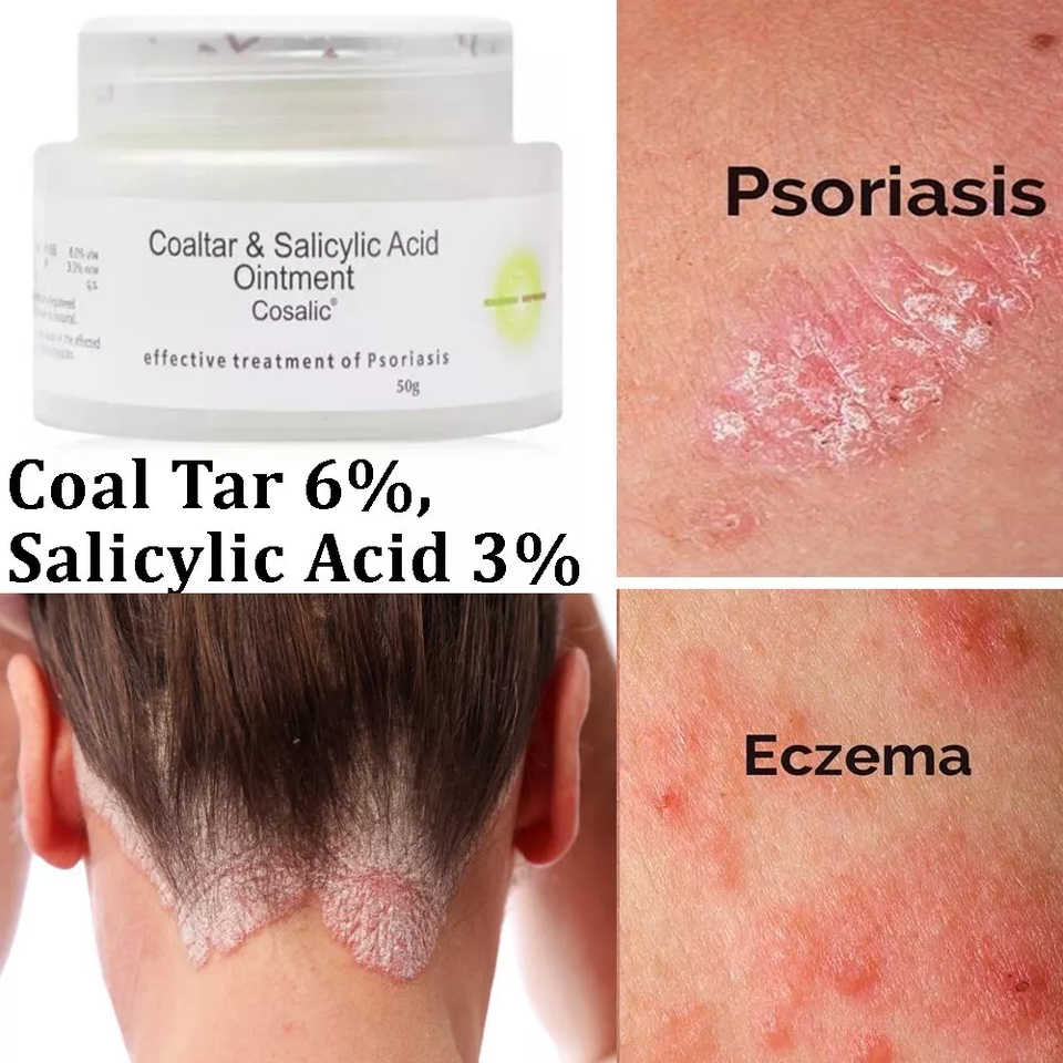 Coal tar & Salicylic Acid Topical Ointment 50g- Hair & Scalp Psoriasis ...