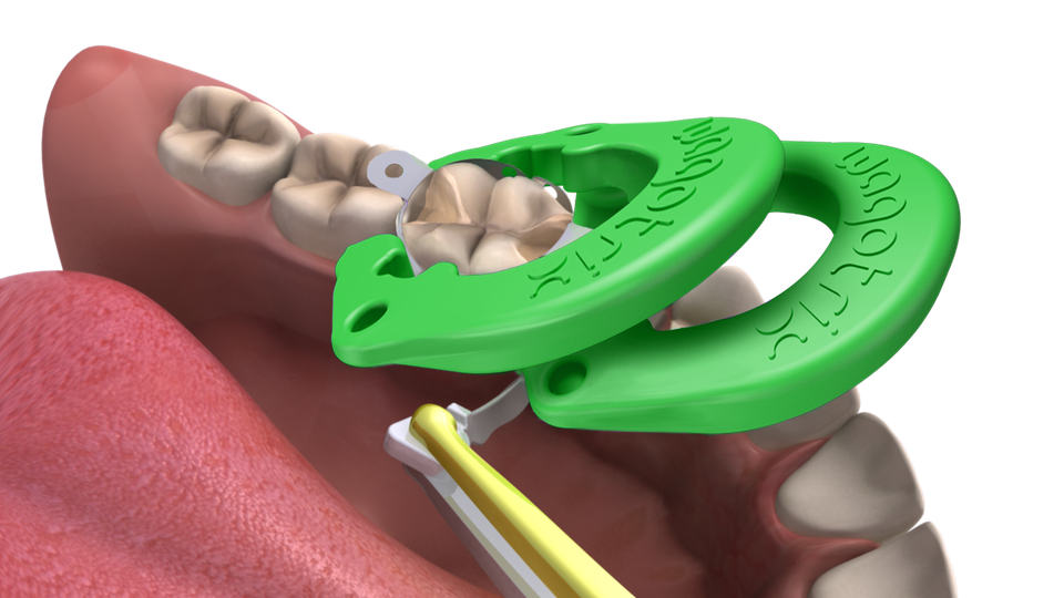 Sectional Matrix System, Dental Rings - Sectional Matrix Rings - Qty 35 ...