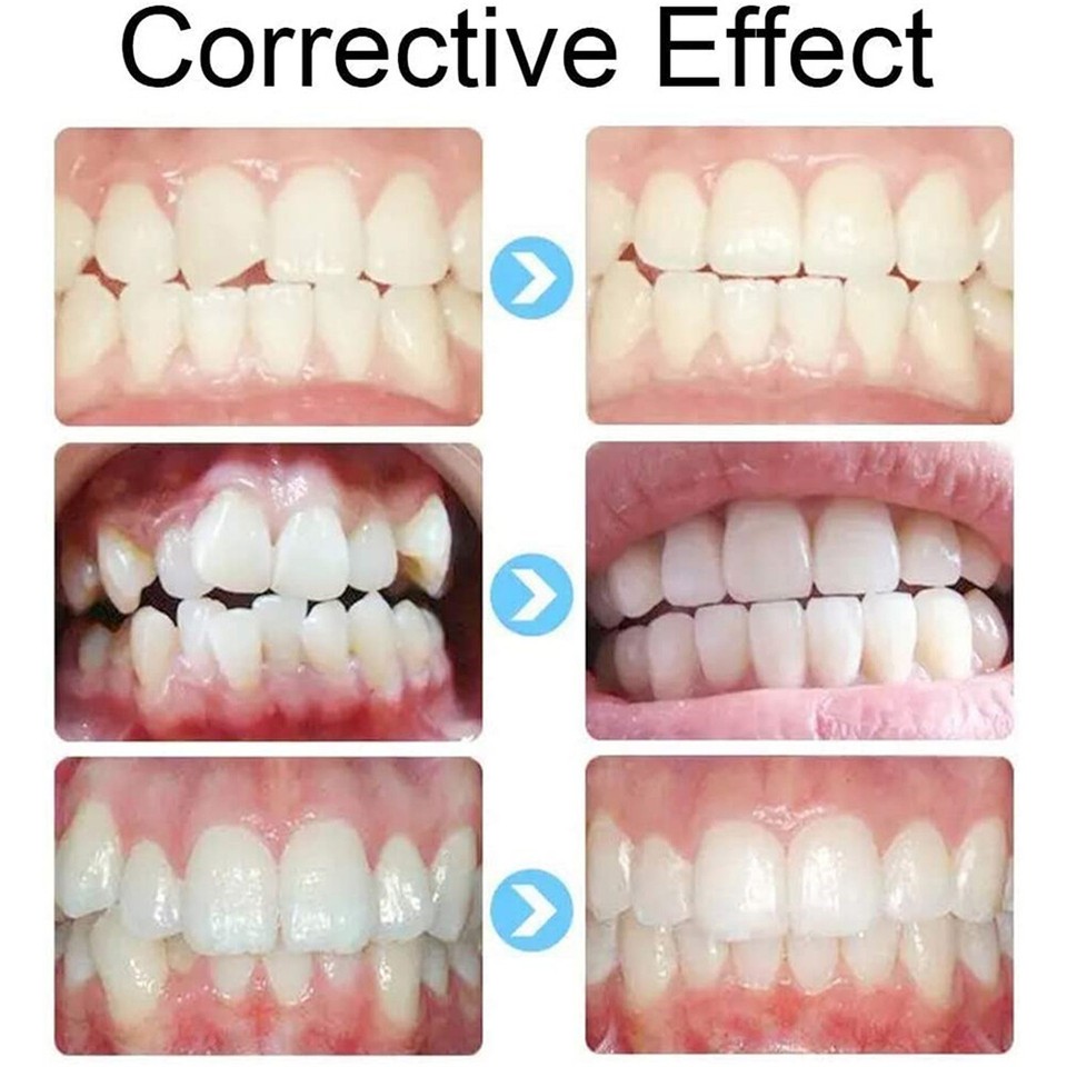 1+2+3 Stages Orthodontic Teeth Corrector Dental Braces Tooth Retainer ...