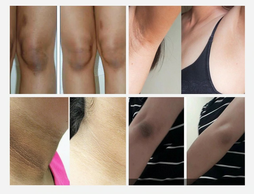 Dark Skin Ultra Whitening Lightening Brightening Age Spot Bleaching Gel ...