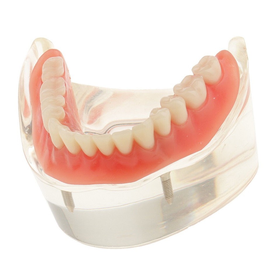 Dental Implant Teeth Model Mandibular Overdenture Restoration 2 Lower ...