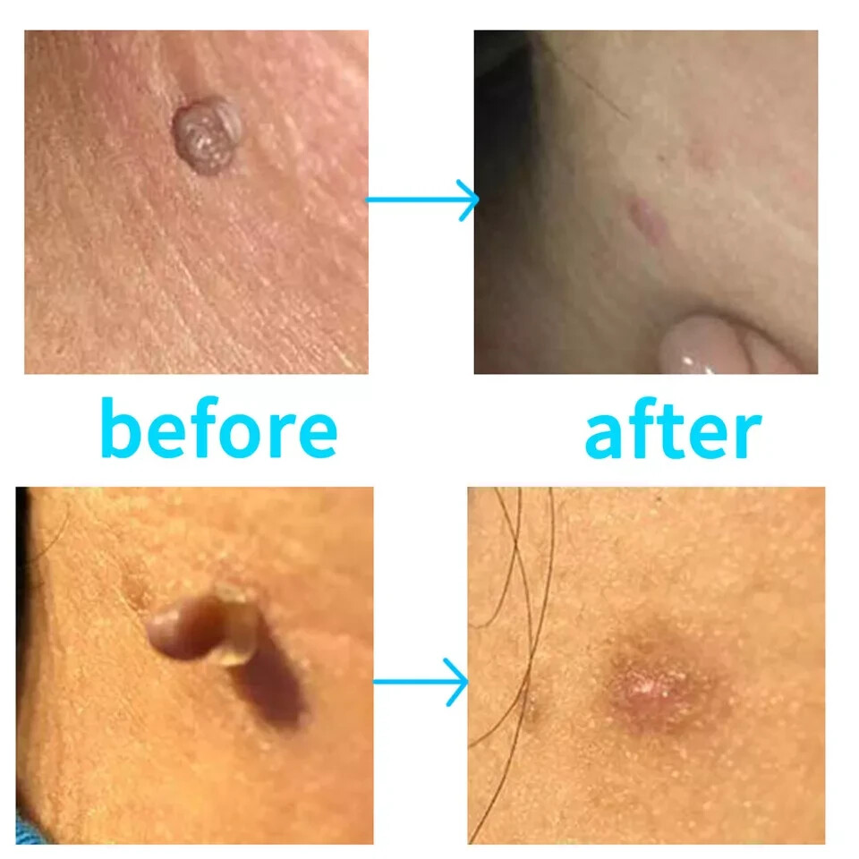 Skin Tag Removal Micro Band Skin Tag Removal Kit Face Body Care ...