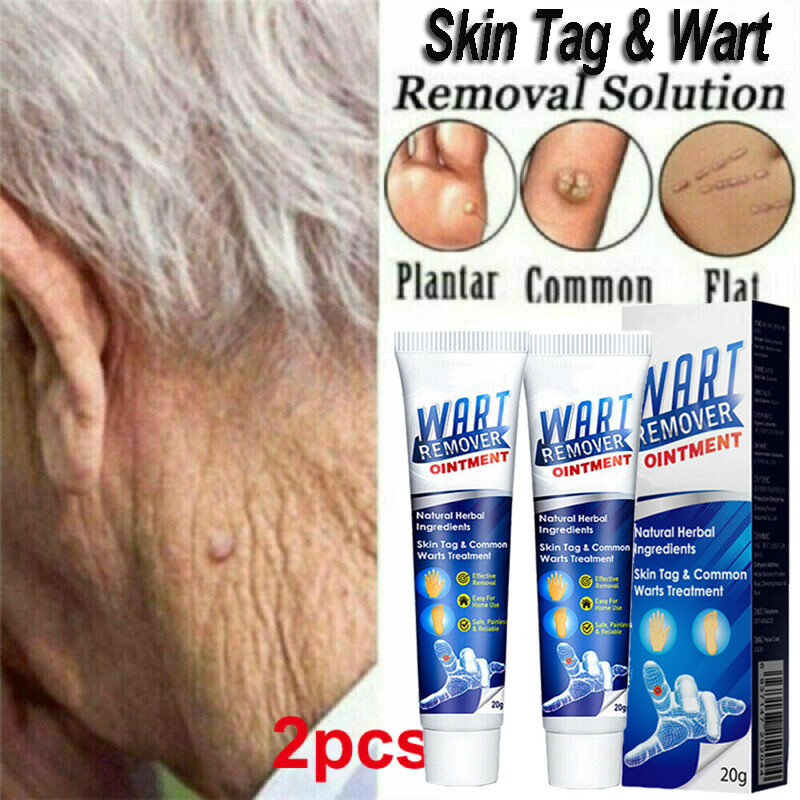 Filiform Wart Removal