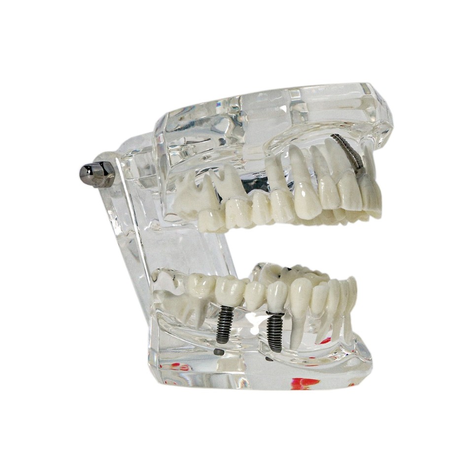 Dental Teeth Model Ortho Practice Teaching Demo Periodontal Disease ...