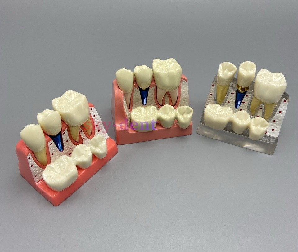Dental Typodont Teeth Model Ortho Implant Pathological Perio Practice ...