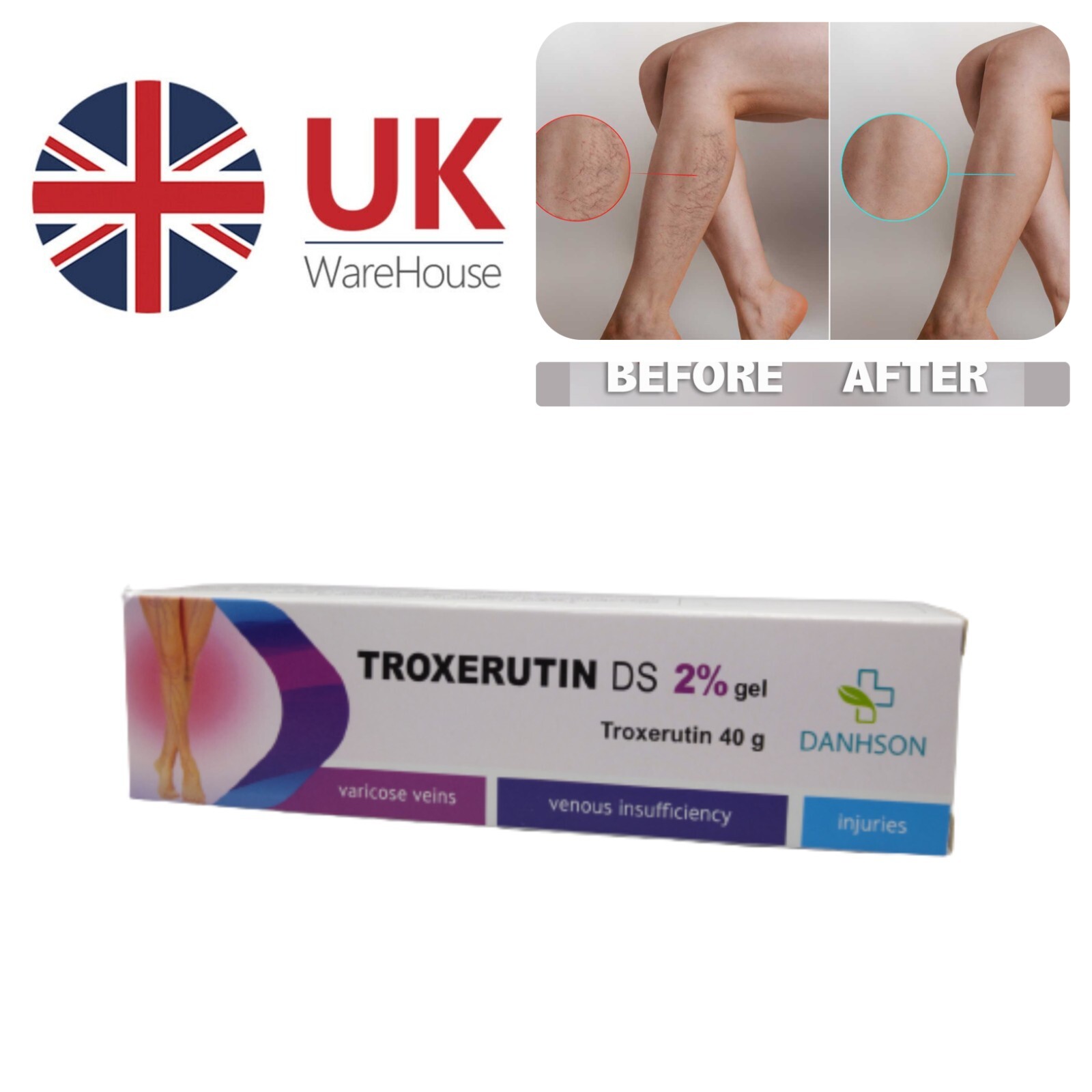 Varicose Spider Veins Cream Vasculitis Legs Treatment Troxerutin Gel ...