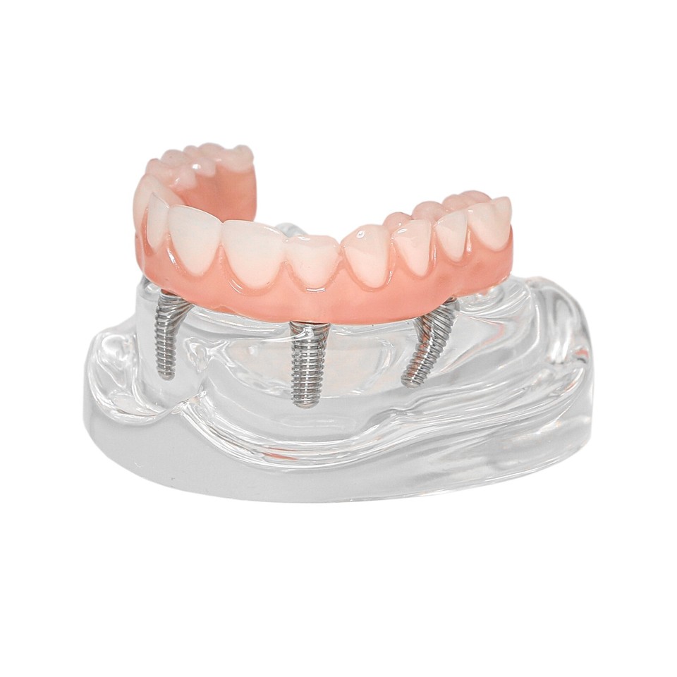 Dental Crown Restoration Model Demonstration With Partial Denture Tooth ...