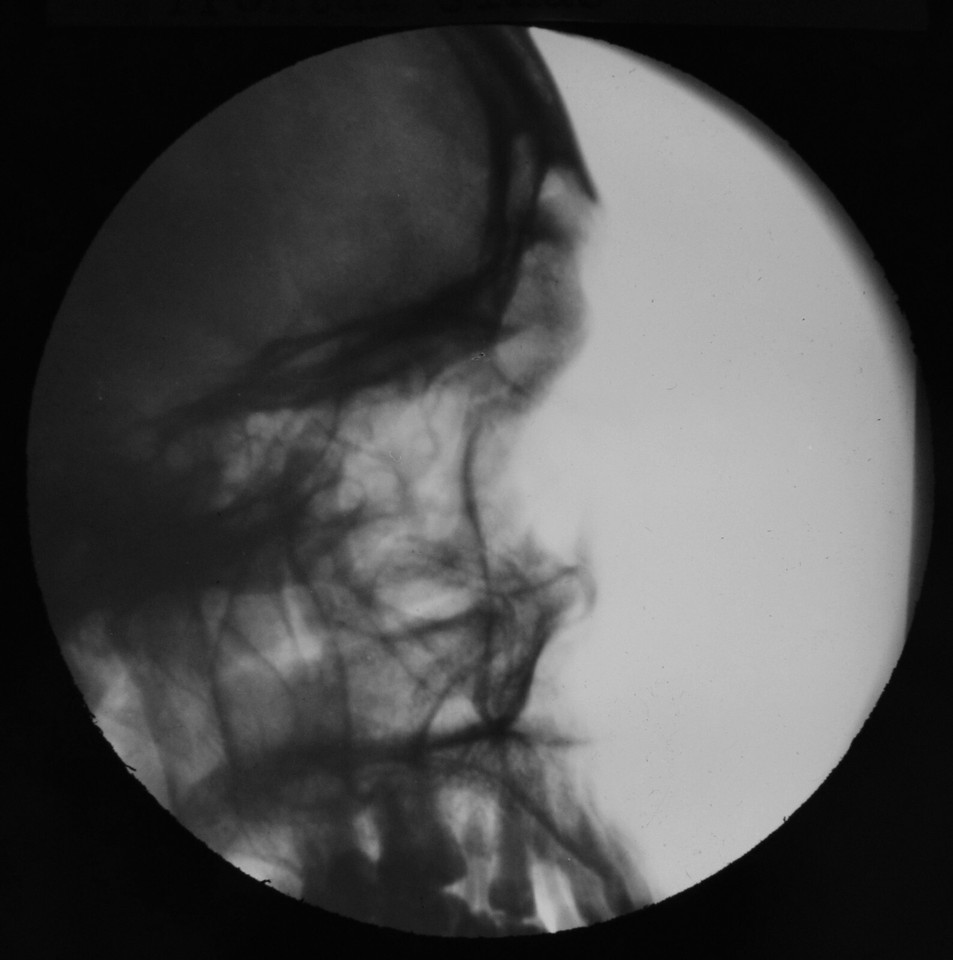 Magic Lantern Slide XRAY COMPOUND FRACTURE FRONTAL SINUS NO2 C1947 ...