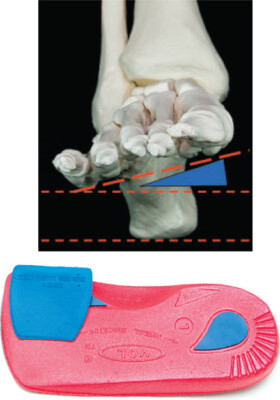 Vasyli Insole Forefoot Varus Wedges - 2 Degree 4 Degree 6 Degree (5 ...