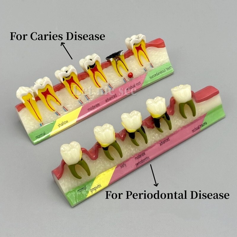 Dental Caries Periodontal Disease Study Teaching Model Teeth Dentoform ...
