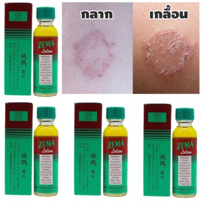 4 bottles x 15ml Zema Lotion Dermatitis Psoriasis Eczema | eBay