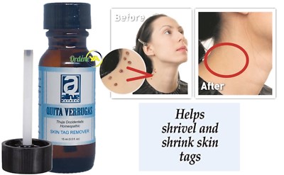 QUITA VERRUGA SKIN TAG REMOVER SANI SKIN WART REMOVER HOMEPATHIC ...