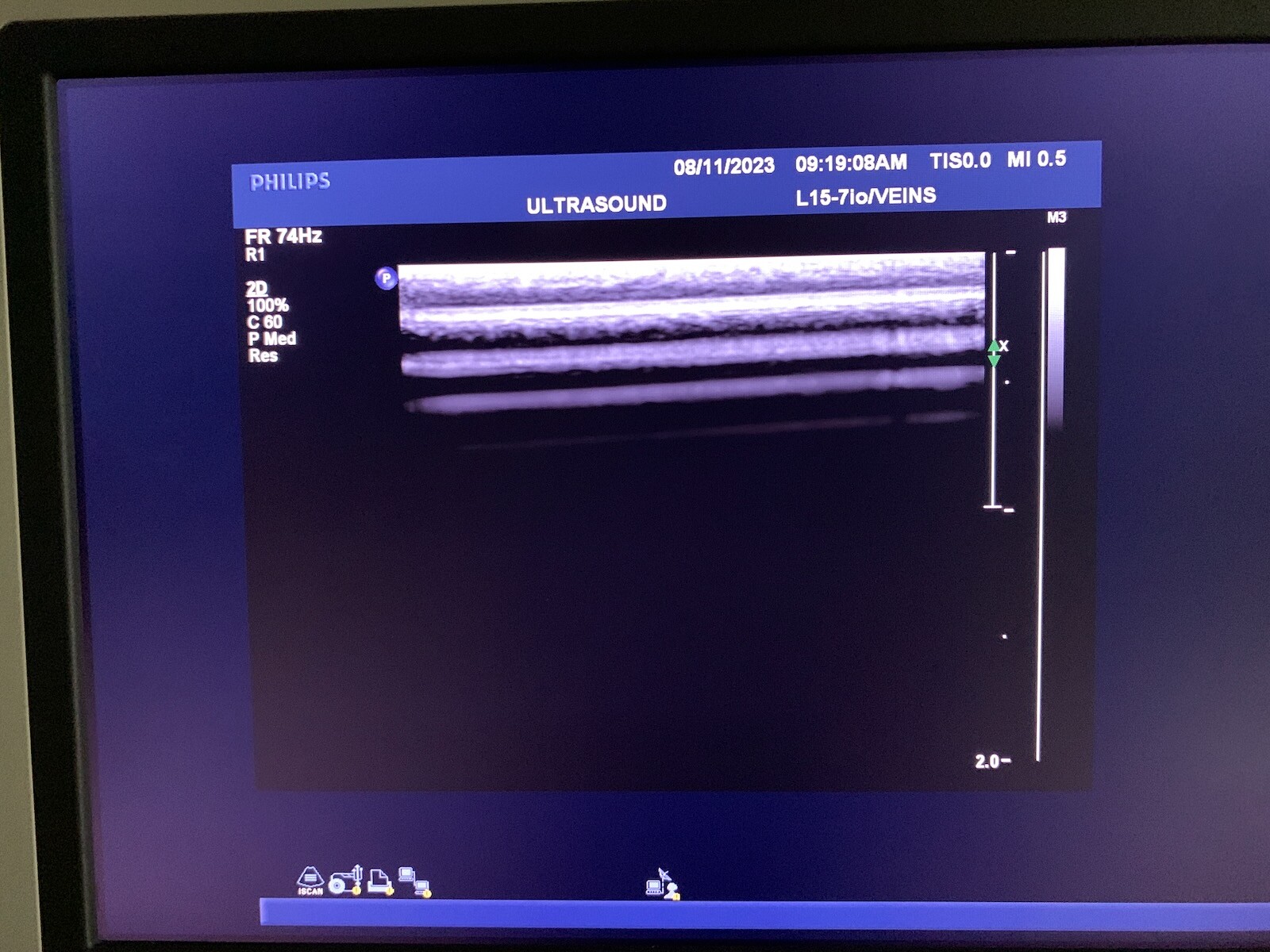 Philips L15-7io Linear Array Hockey Stick Ultrasound Transducer Probe ...