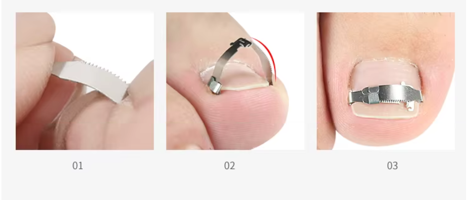 Ingrown Toenail Straightening Clip Stainless Steel Toenail Correction ...