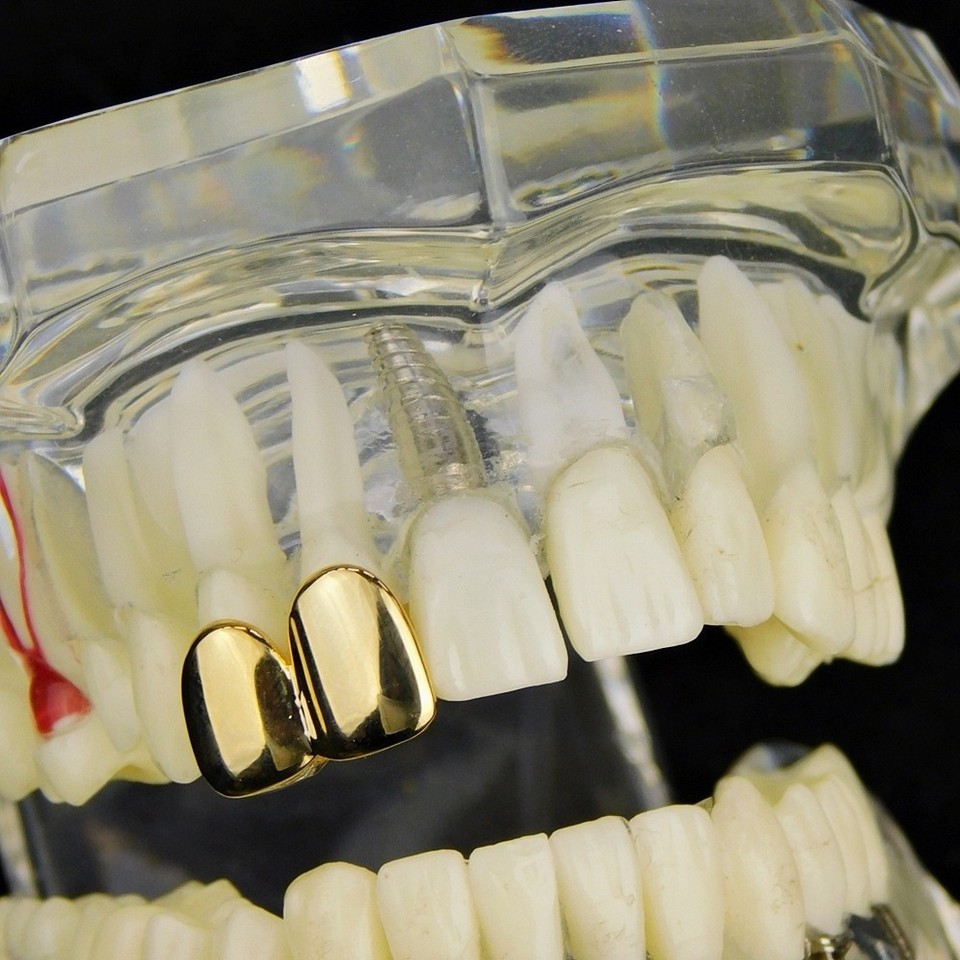 Double Cap 14k Gold Plated Grillz Canine Plain Two Teeth Right Single ...