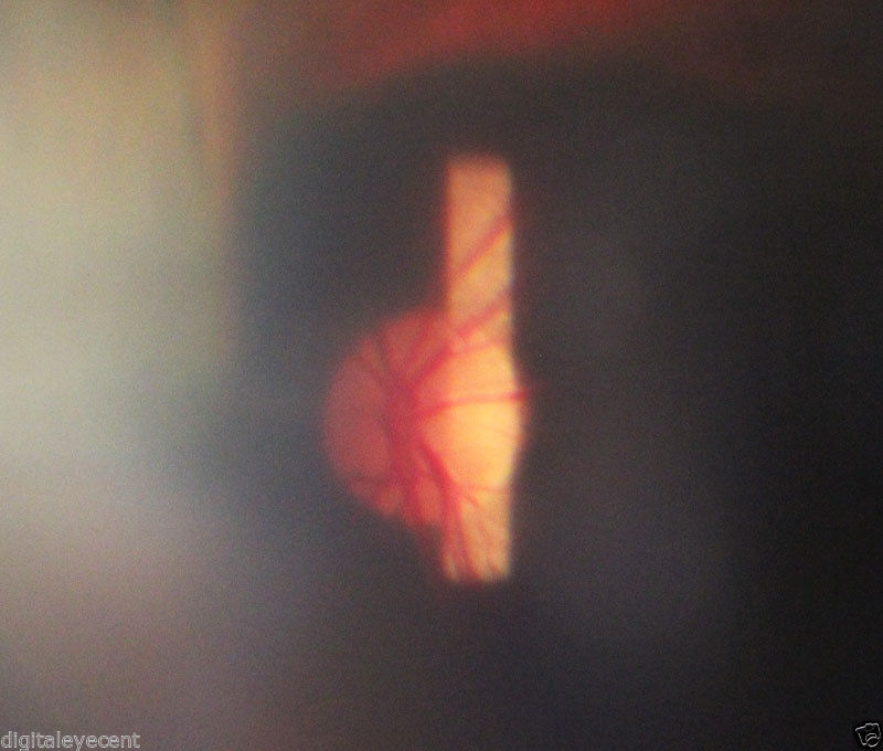 New Slit Lamp Camera Adapter SET for Zeiss SL 120 and 130 | eBay