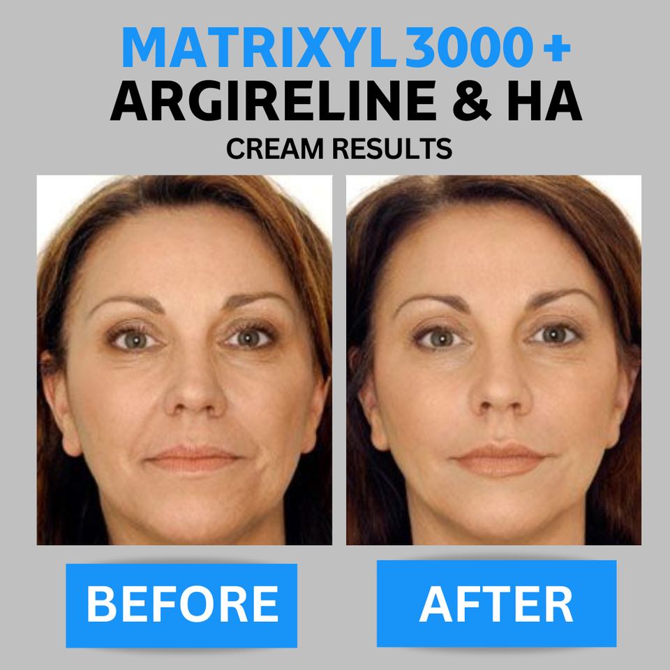 2 Pk - Matrixyl 3000, Argireline Hyaluronic Acid AntiAging Wrinkle ...