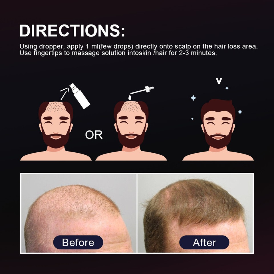 Finally Hair Regrowth Spray or Dropper with 5% Minoxidil Biotin ...