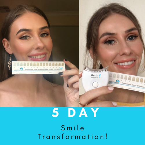 TEETH WHITENING KIT DENTIST STRENGTH WHITE SMILE MATRIX SUPER LED ...