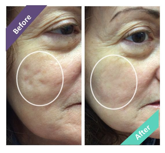 Dermaflage Single Applicator Topical Scar Filler 5.5g Medium for sale ...