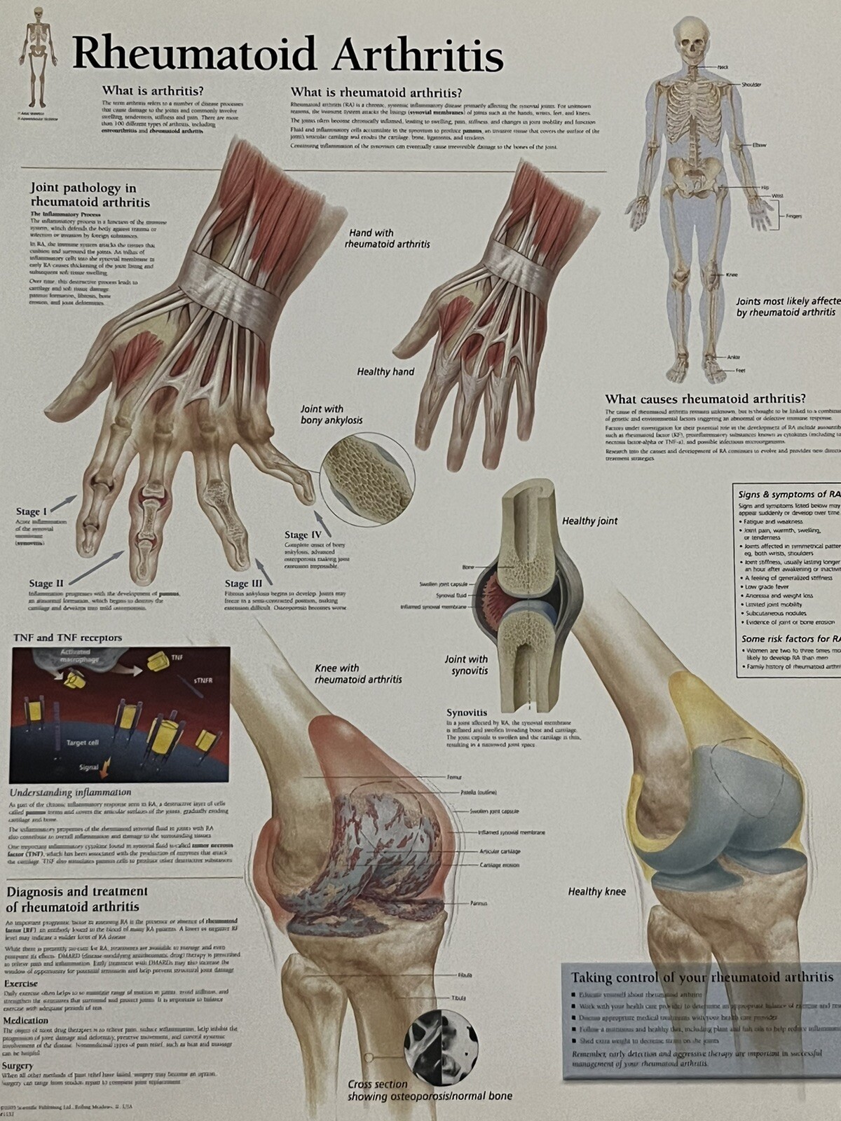 Rheumatoid Arthritis ~ Anatomy Poster ~ 11.25 x 14 | eBay