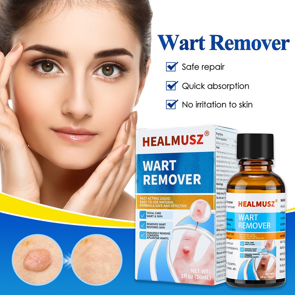 Wart Remover Liquid Skin Tag Mole Remover Eliminate Feet Corn Wart ...