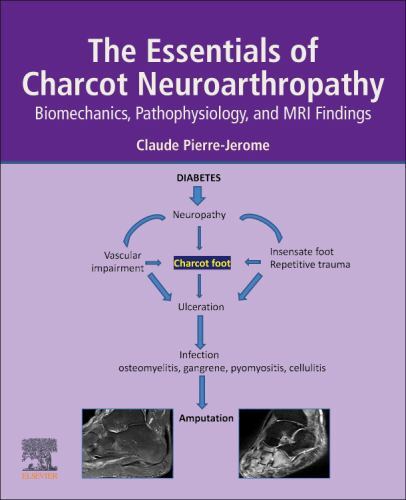 The Essentials of Charcot Neuroarthropathy : Biomechanics ...