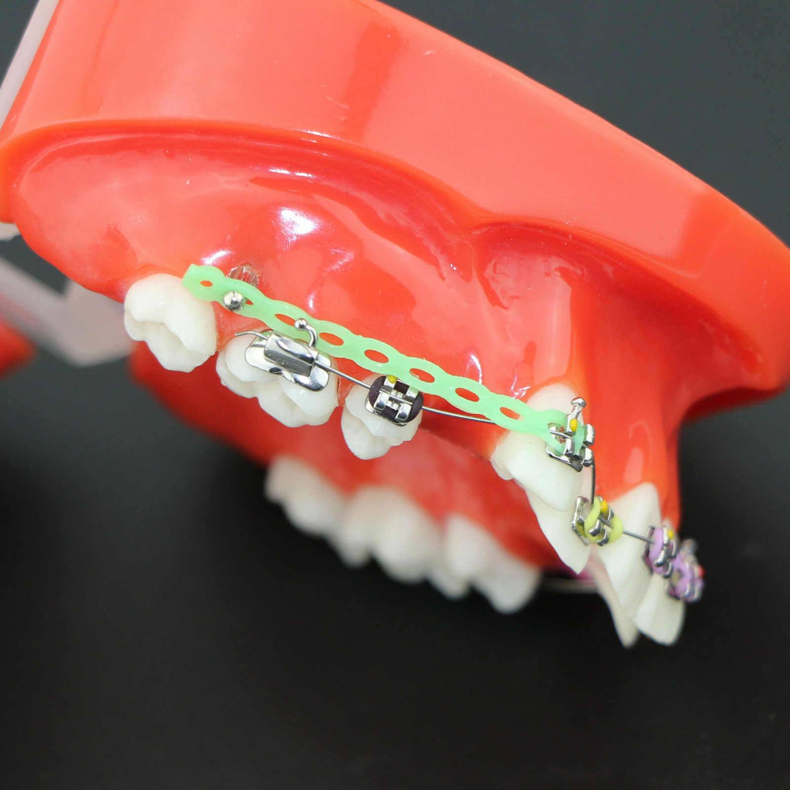 Dental Orthodontics Treatment Model With Metal Brackets Arch Wires Ties ...