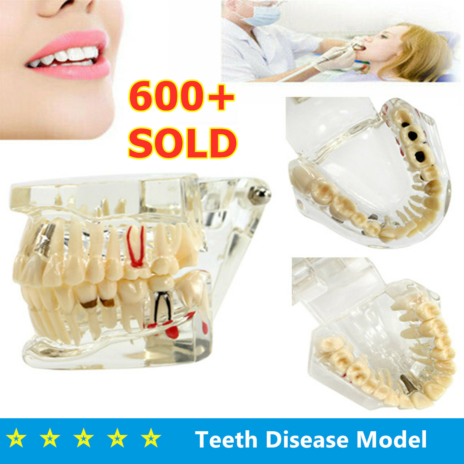 Dental Fake Teeth Study Model Implant Disease Education Denture Teach ...