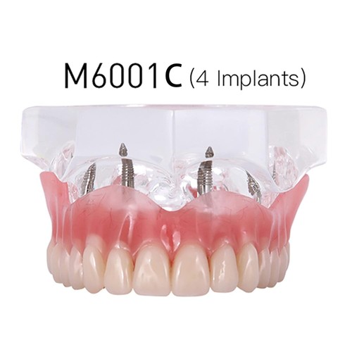 Dental Implant Overdenture Upper Maxillary Model with 4 Implants Demo ...